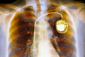 Origen del Marcapasos - Inventor y Evolución | CurioSfera-Historia.com